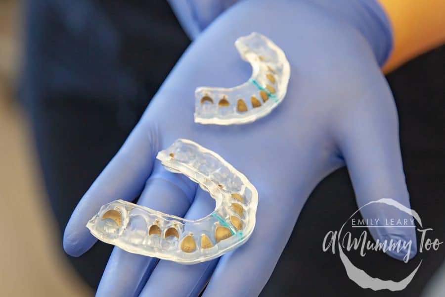 Lingual (hidden) braces - my fitting experience